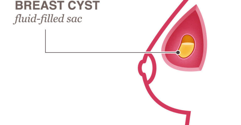 Breast Cyst – DR JAMILA ALAZHRI